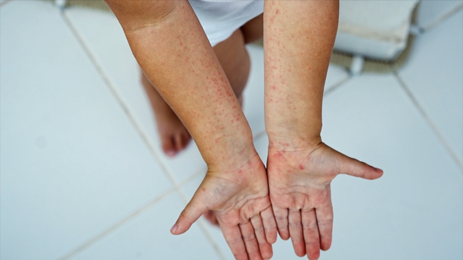 THA Division Implements Measures To Manage Rise In HFMD Cases - TTT News
